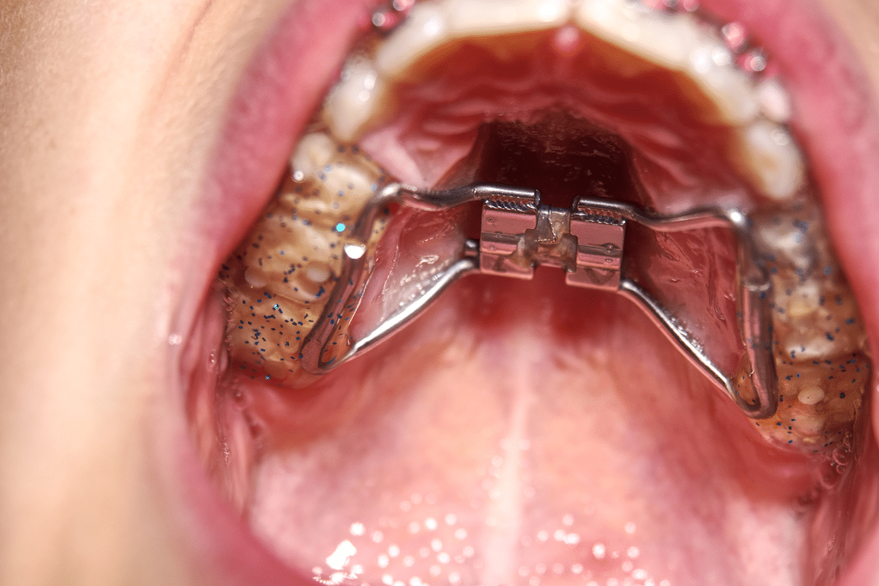 Apparecchio per allargare il palato: Guida e Consigli